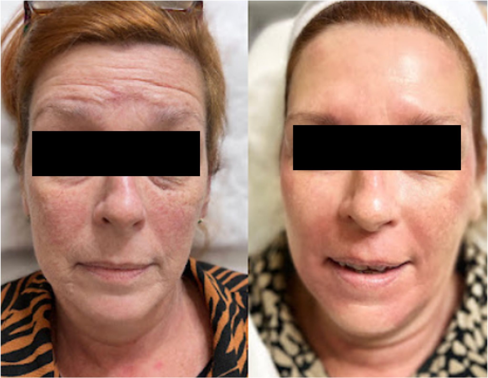 Profhilo - Primas Medispa